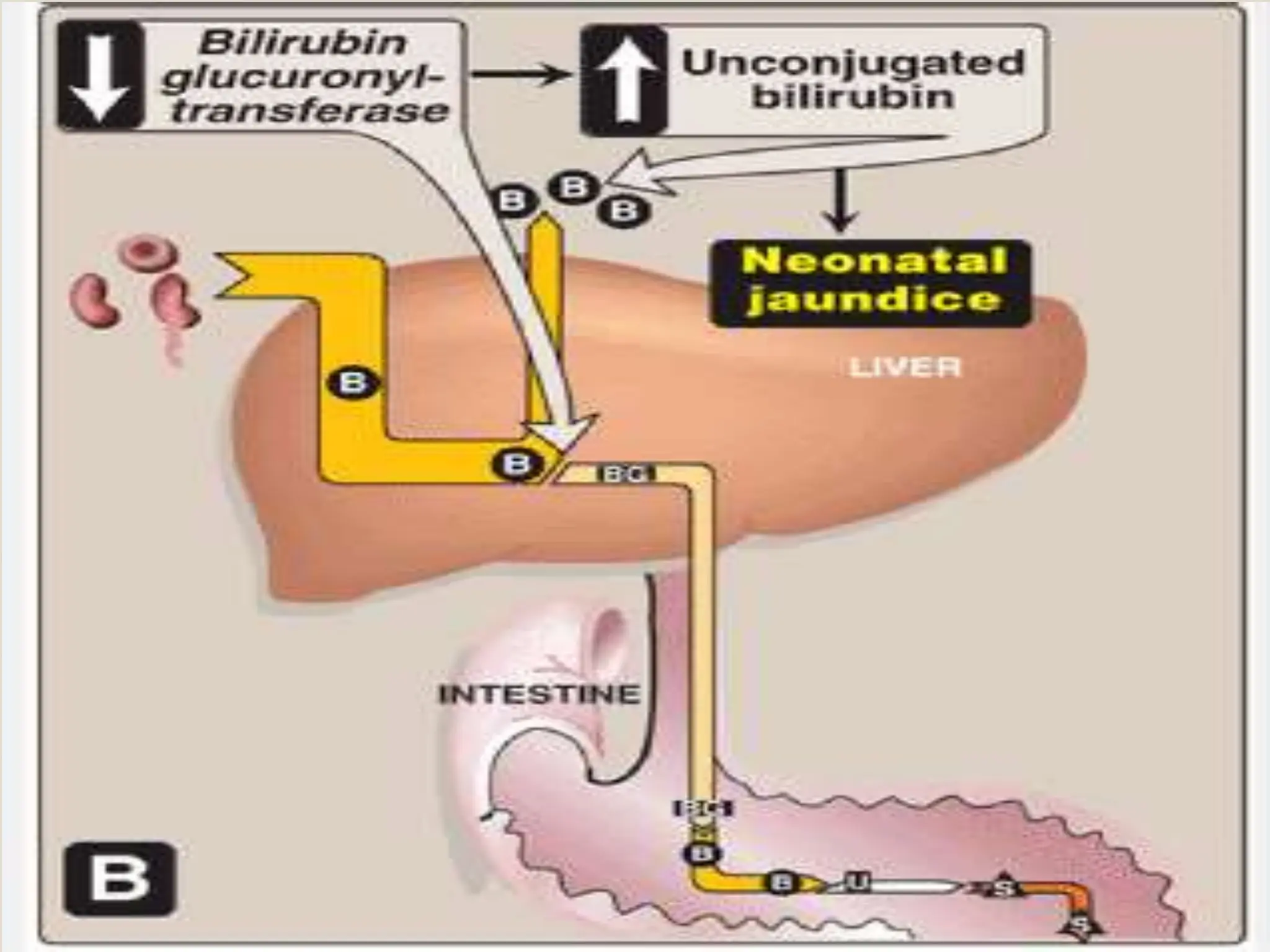 jaundice-(three types)- pre hepatic, hepatic , post hepatic | PDF