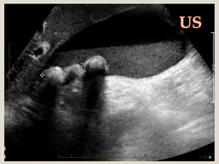 jaundice-(three types)- pre hepatic, hepatic , post hepatic | PDF