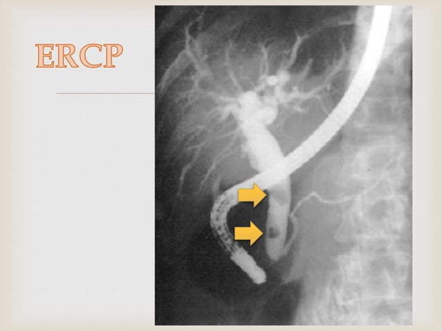 jaundice-(three types)- pre hepatic, hepatic , post hepatic | PDF ...