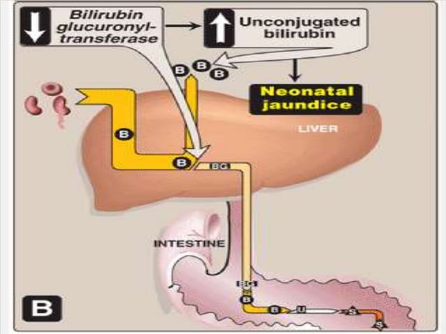 jaundice-(three types)- pre hepatic, hepatic , post hepatic | PDF ...