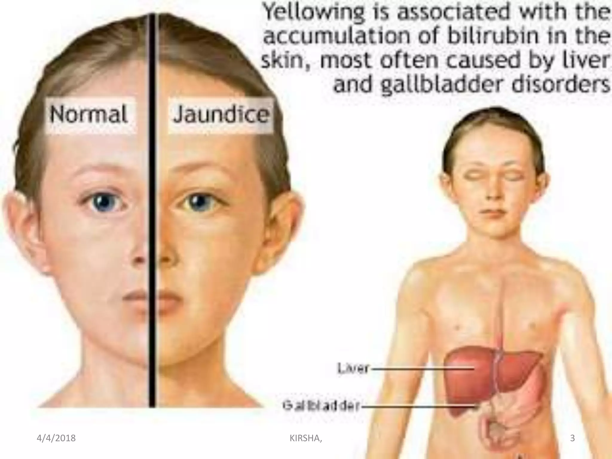 Jaundice | PPTX