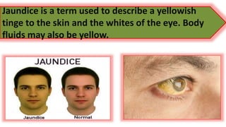 Jaundice | PPT
