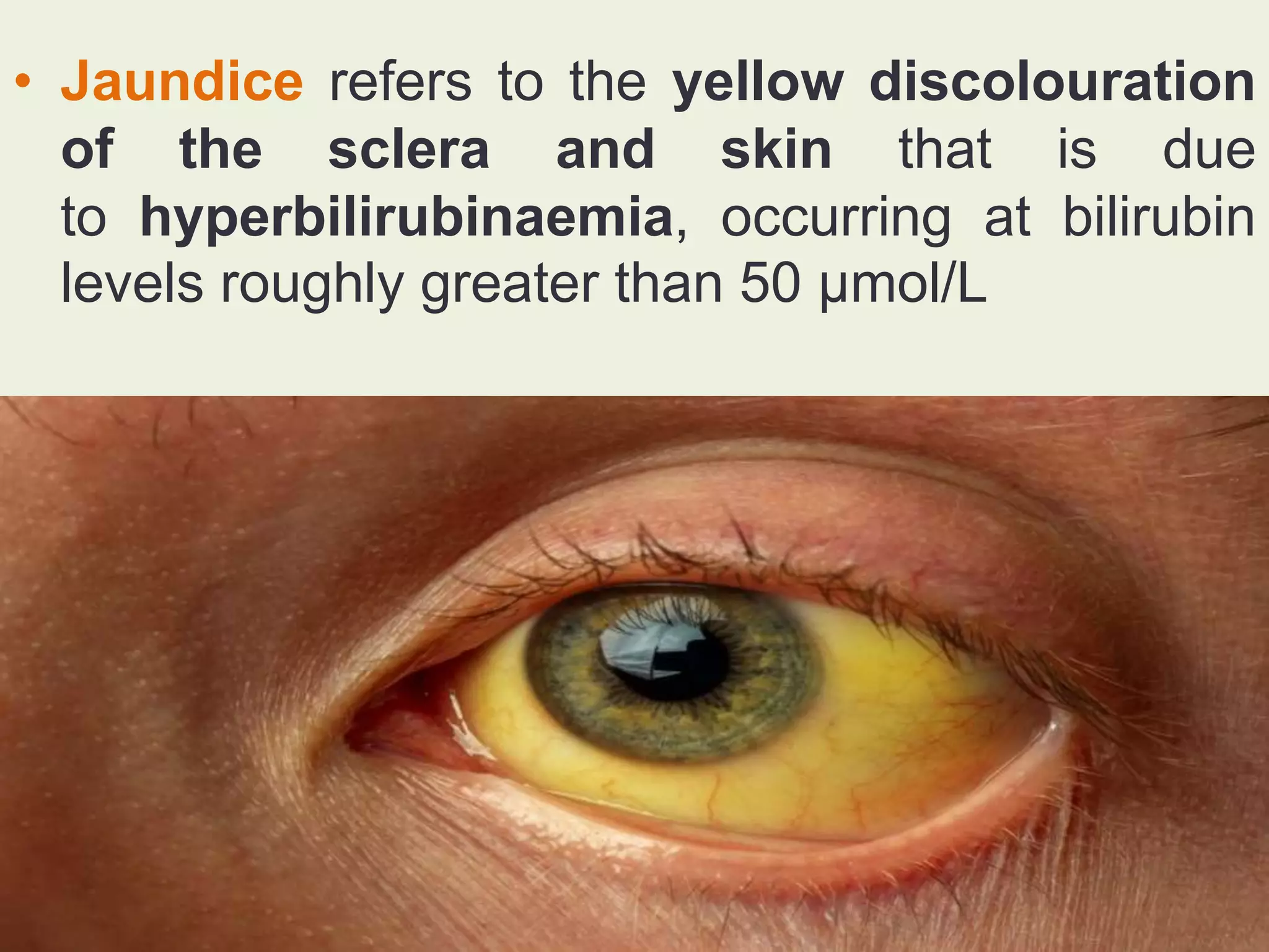Jaundice.pptx