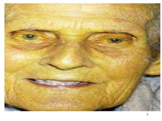 Yellow Skin Jaundice