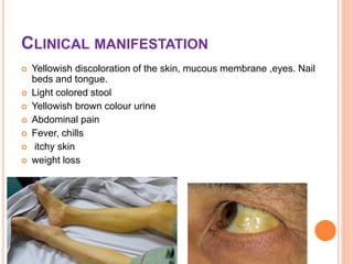 JAUNDICE. GI disorders ... everything... | PPTX