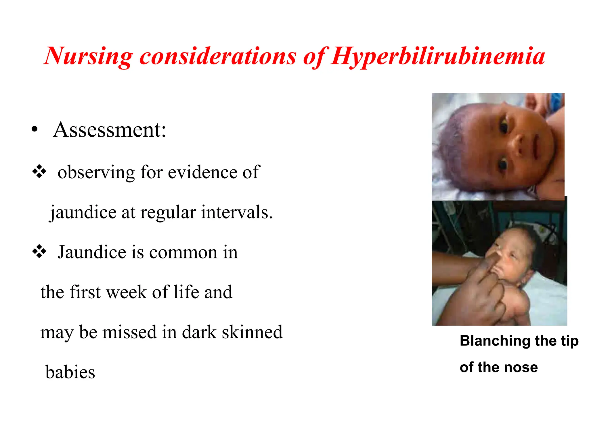 jaundice bsc nursing students ppt for teaching | PPT