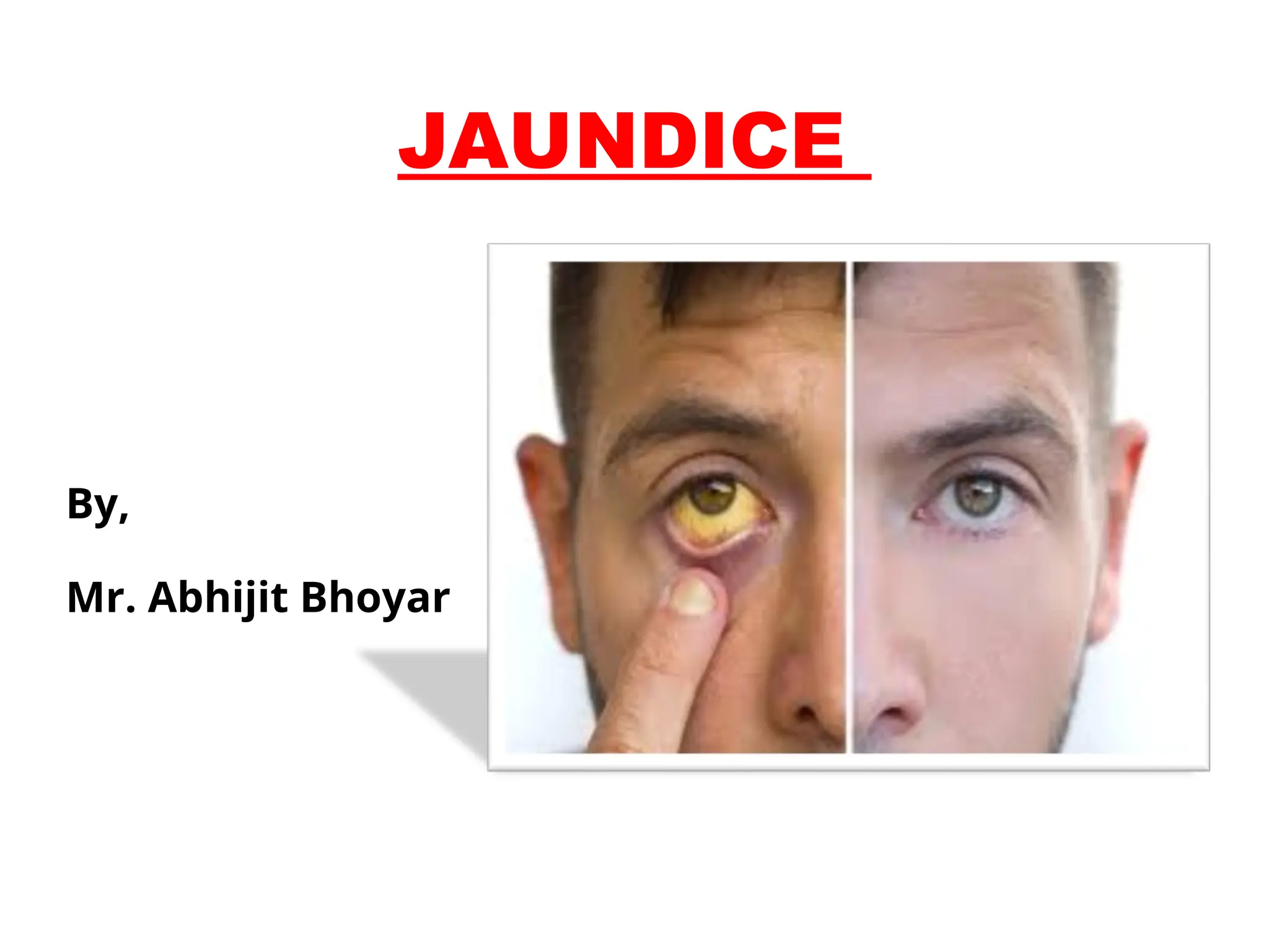 JAUNDICE-.ppt_Biochemistry for nursing students | PPT | Blood Disorders ...