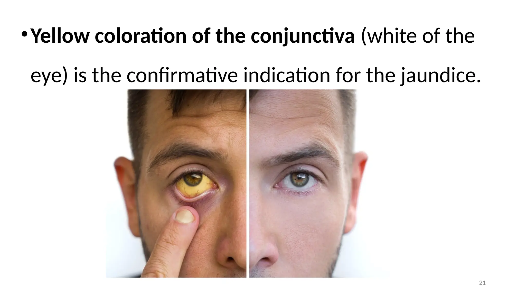 PATHOPHYSIOLOGY OF JAUNDICE AND ITS TYPES.pptx