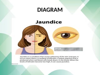 Jaundice Unveiled: Understanding Its Pathophysiology | PPTX