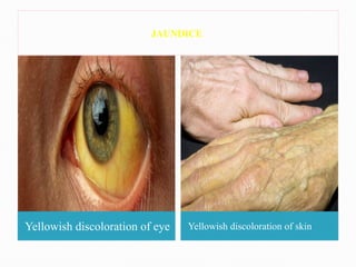 JAUNDICE | PPTX