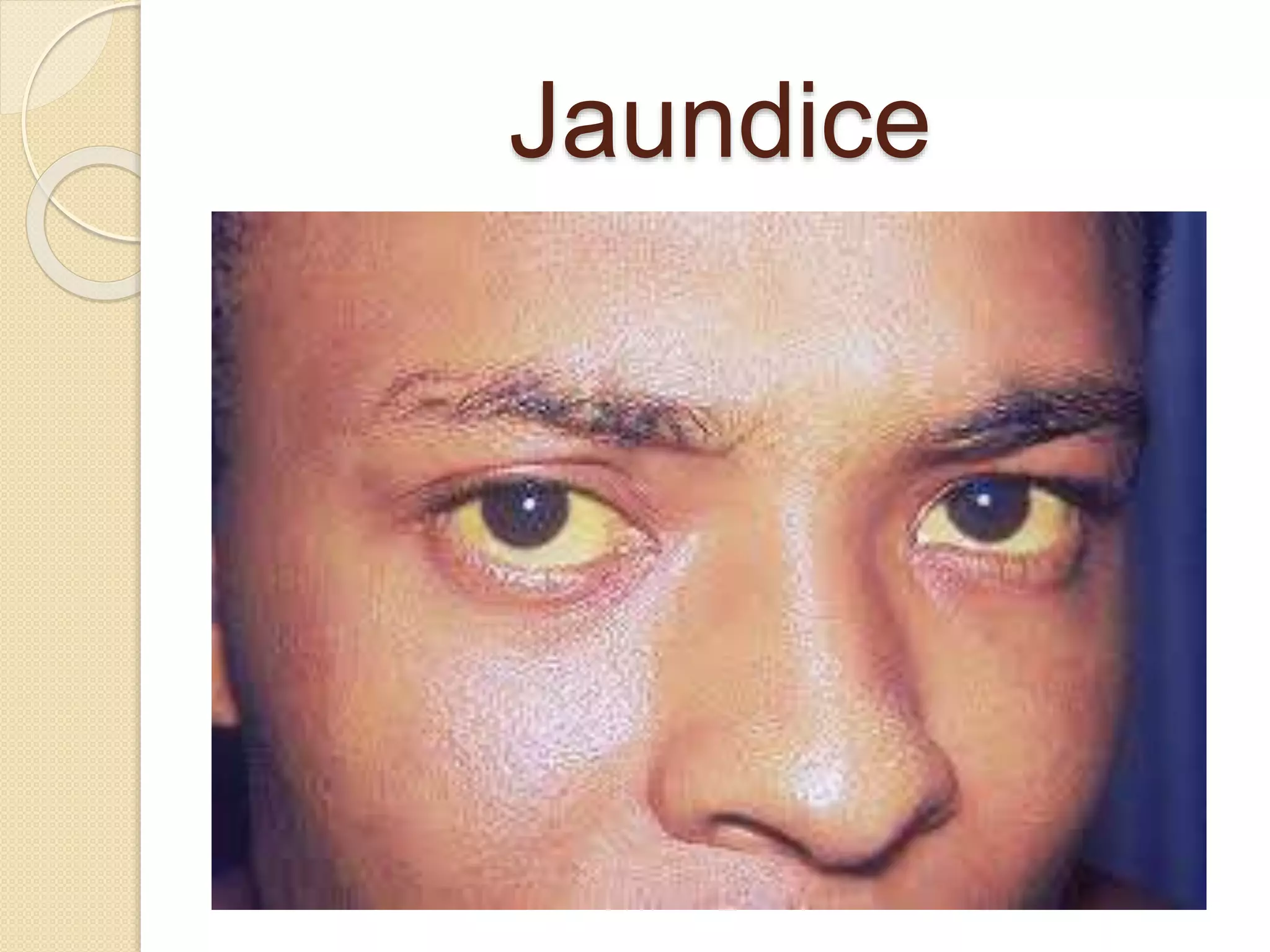 Jaundice | PPT