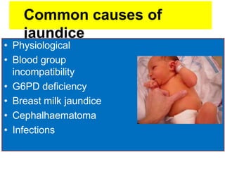 jaundice-mnb.pptx