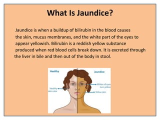 Jaundice13 | PPTX