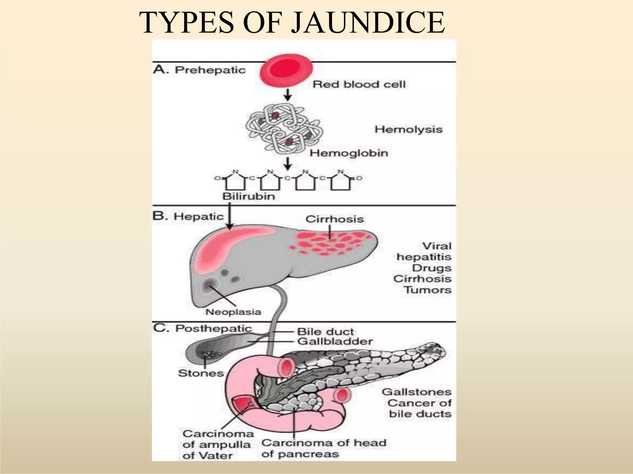 jaundice 22.pptx