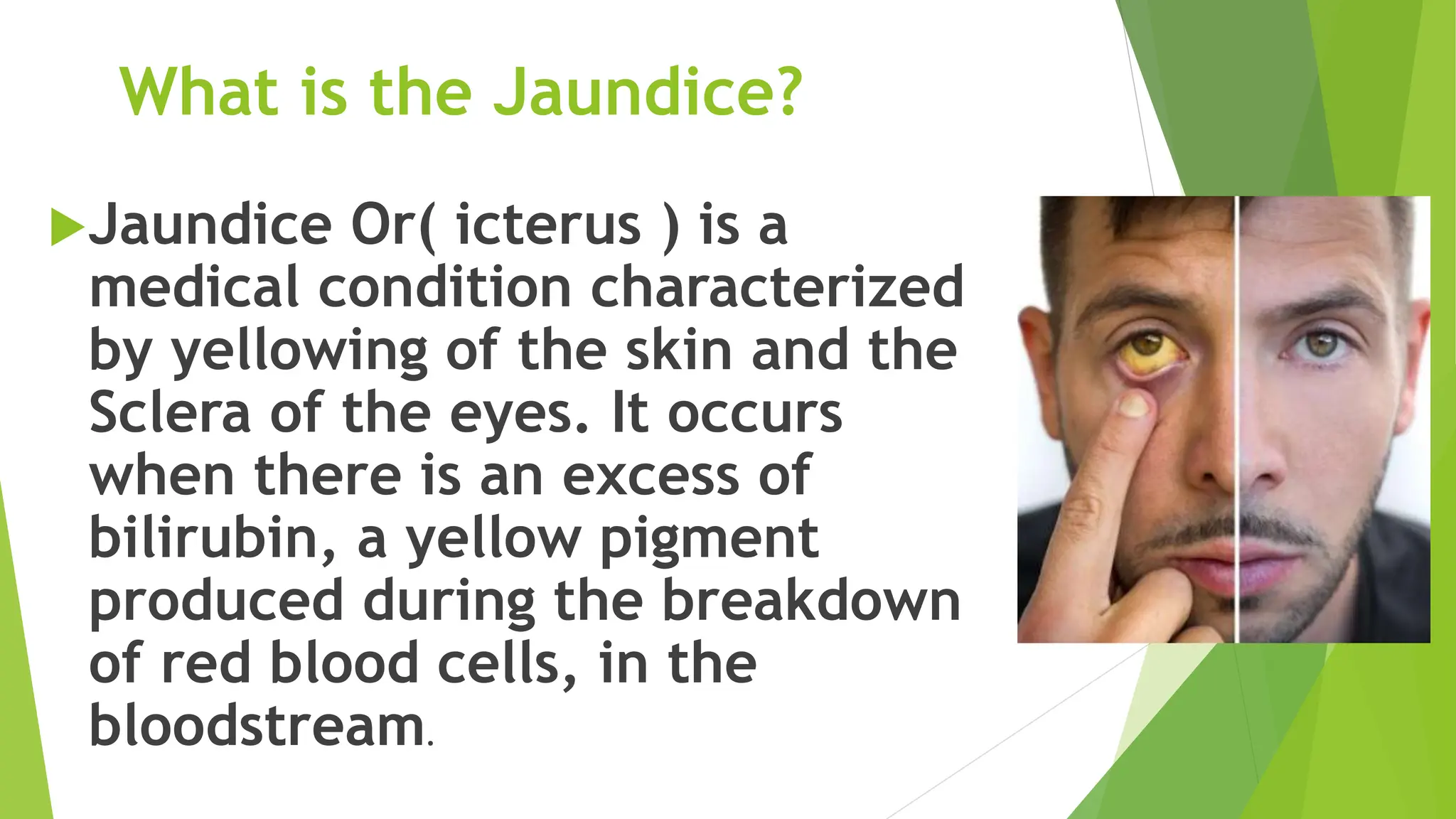 Jaundice :Definition, diagnosis, Causes. | PPTX