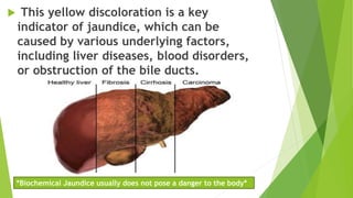 Jaundice :Definition, diagnosis, Causes. | PPTX