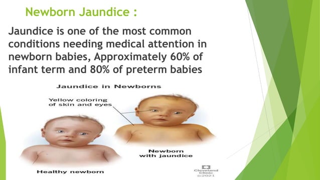 Jaundice :Definition, diagnosis, Causes. | PPTX