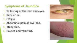 Jaundice :Definition, diagnosis, Causes. | PPTX