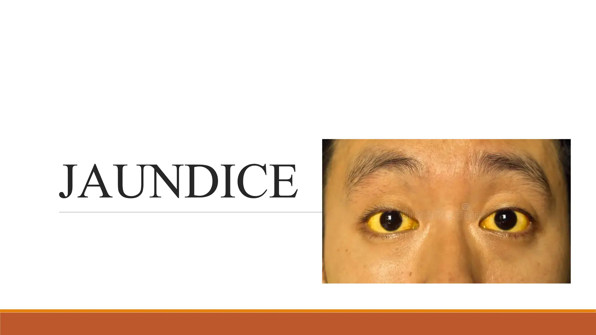 JAUNDICE CLINICAL METHODS with types, bilirubin metabolism.pdf
