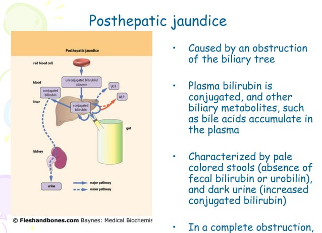 Jaundice - Etiology, pathogenesis, Clinical features, Investigation ...