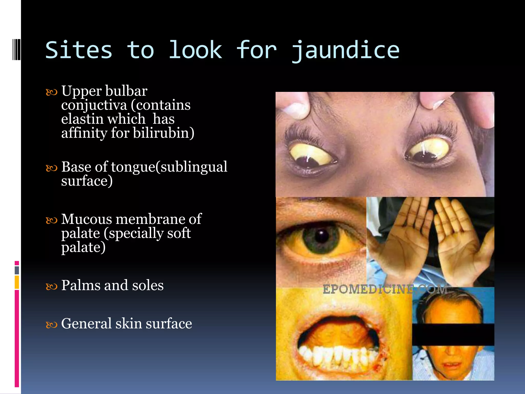 Jaundice general survey | PPTX