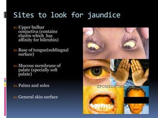 Jaundice general survey | PPT