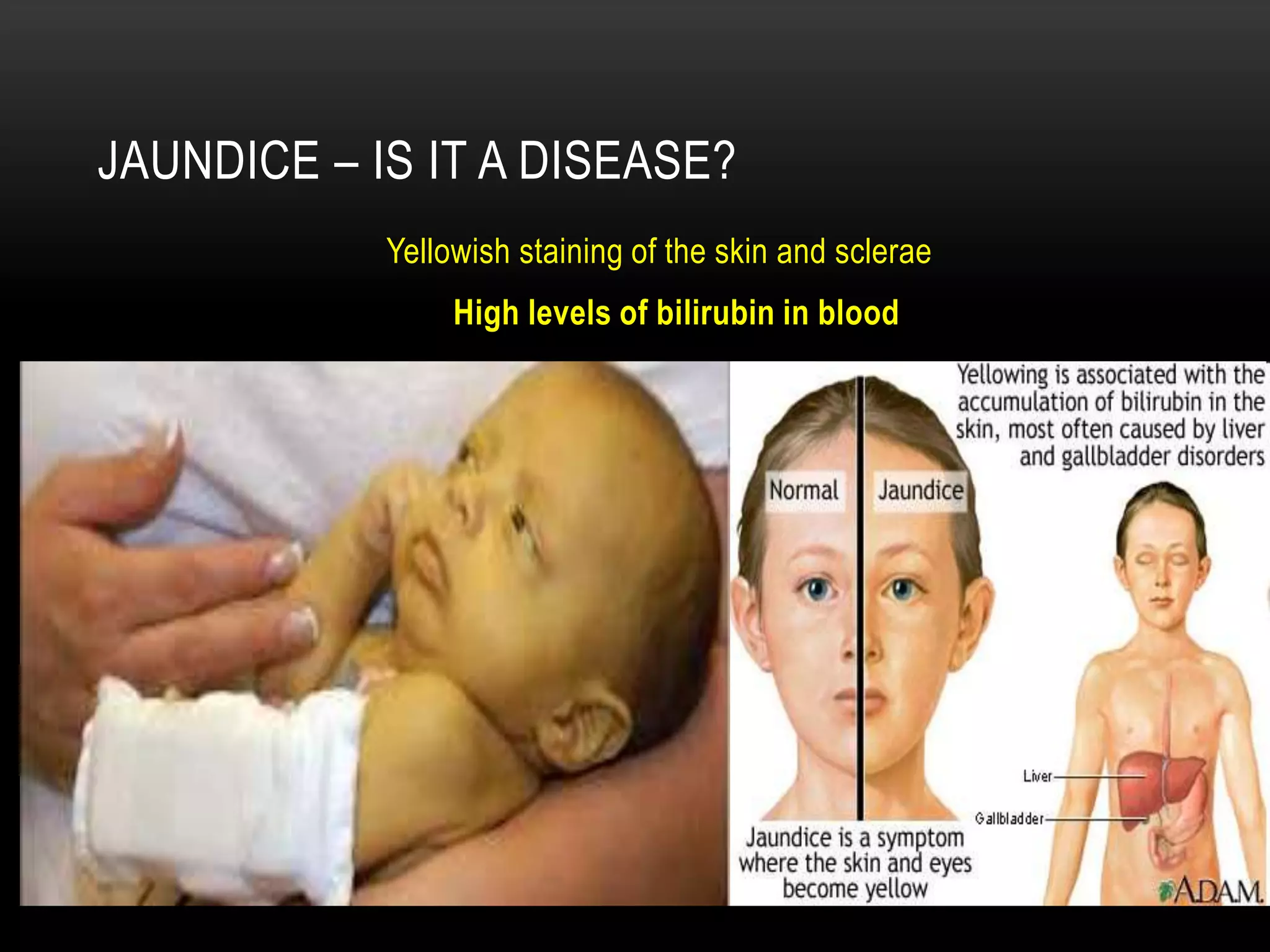 Jaundice in Children | PPTX