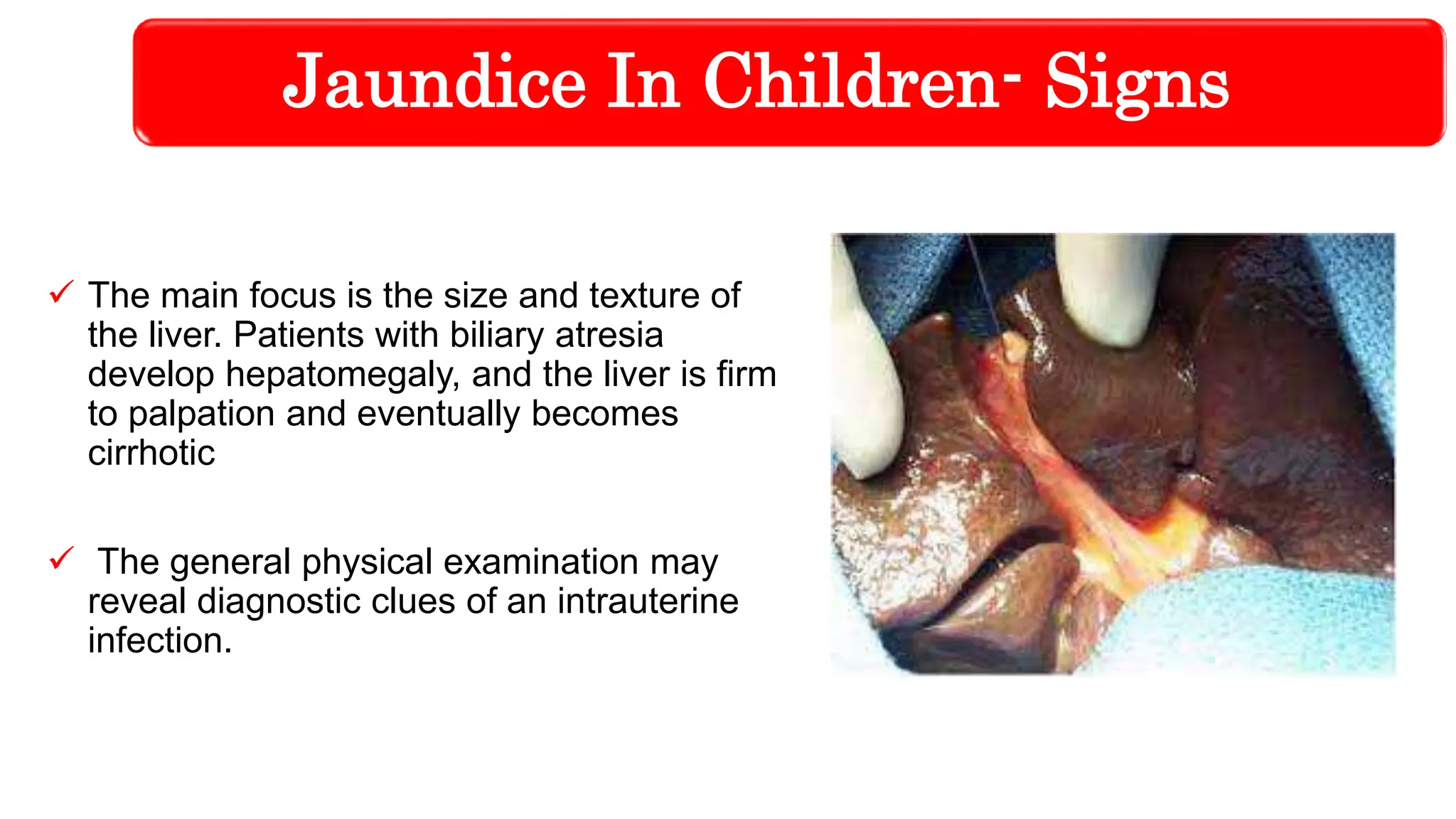 JAUNDICE IN CHILDREN- Surgical Perspective.pptx