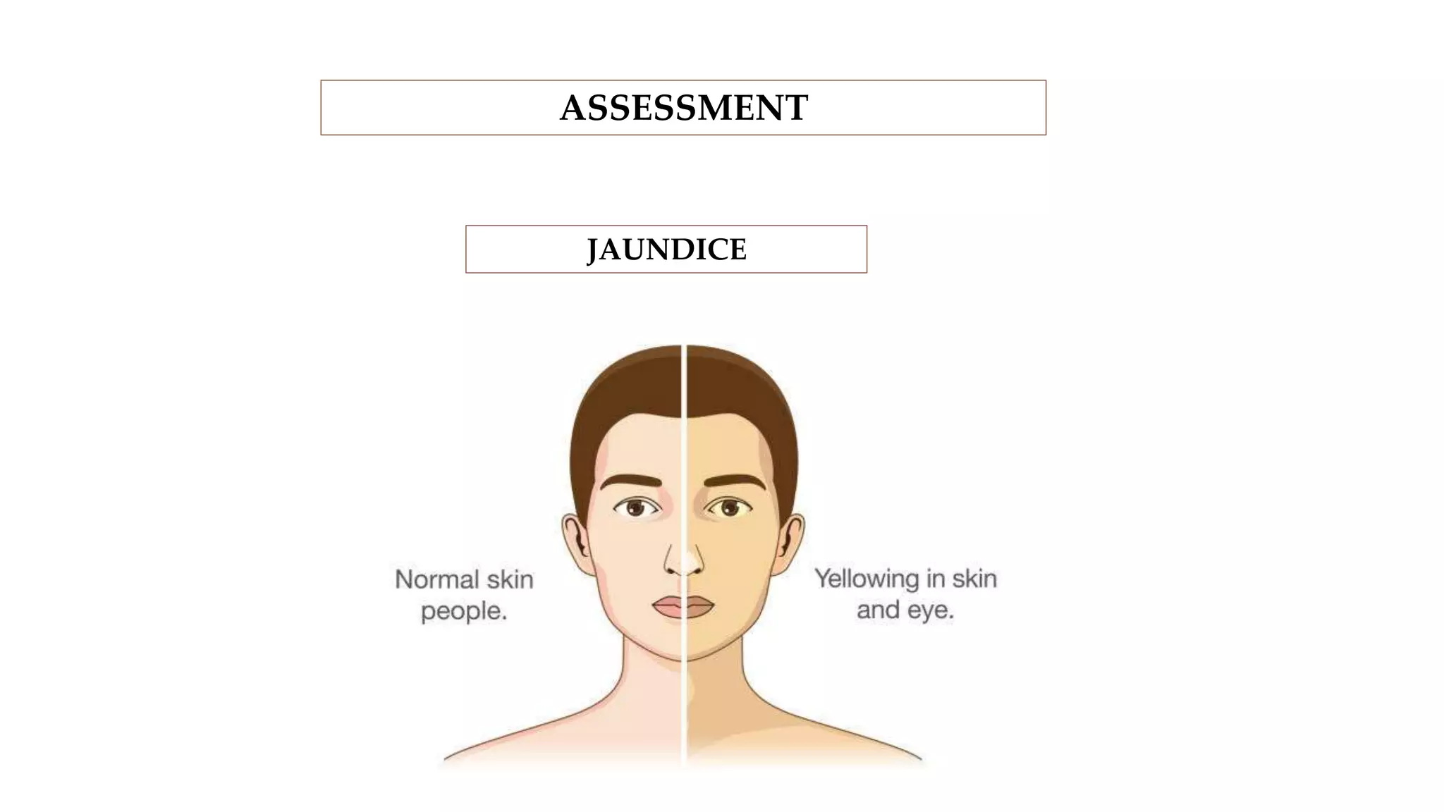 CASE PRESENTATION ON JAUNDICE | PPTX