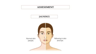 CASE PRESENTATION ON JAUNDICE | PPTX