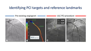 Javier Escaned: 3 Low contrast complex and CTO PCI | PDF