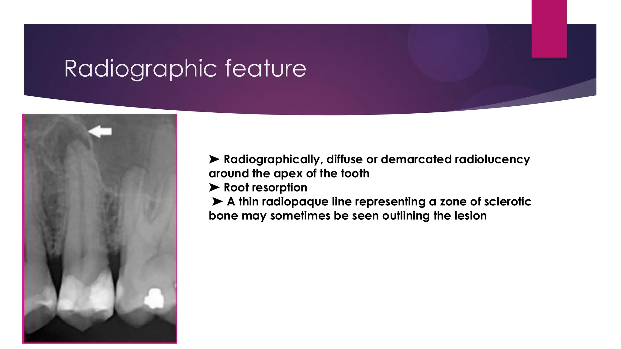 Acute periodontitis caries apical periodontitis | PDF