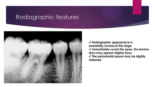 Acute periodontitis caries apical periodontitis | PDF