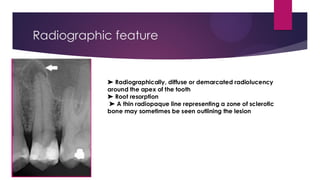 Acute periodontitis caries apical periodontitis | PDF