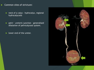 Male Genito-Urinary Tuberculosis | PPTX