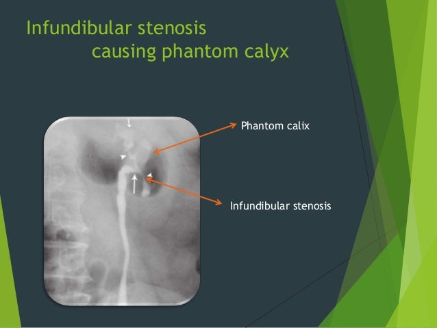 Male Genito-Urinary Tuberculosis