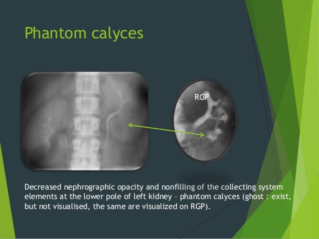 Male Genito-Urinary Tuberculosis