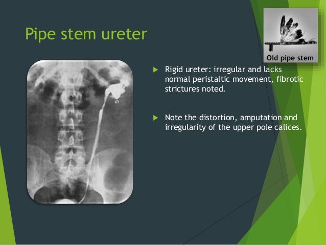 Male Genito-Urinary Tuberculosis