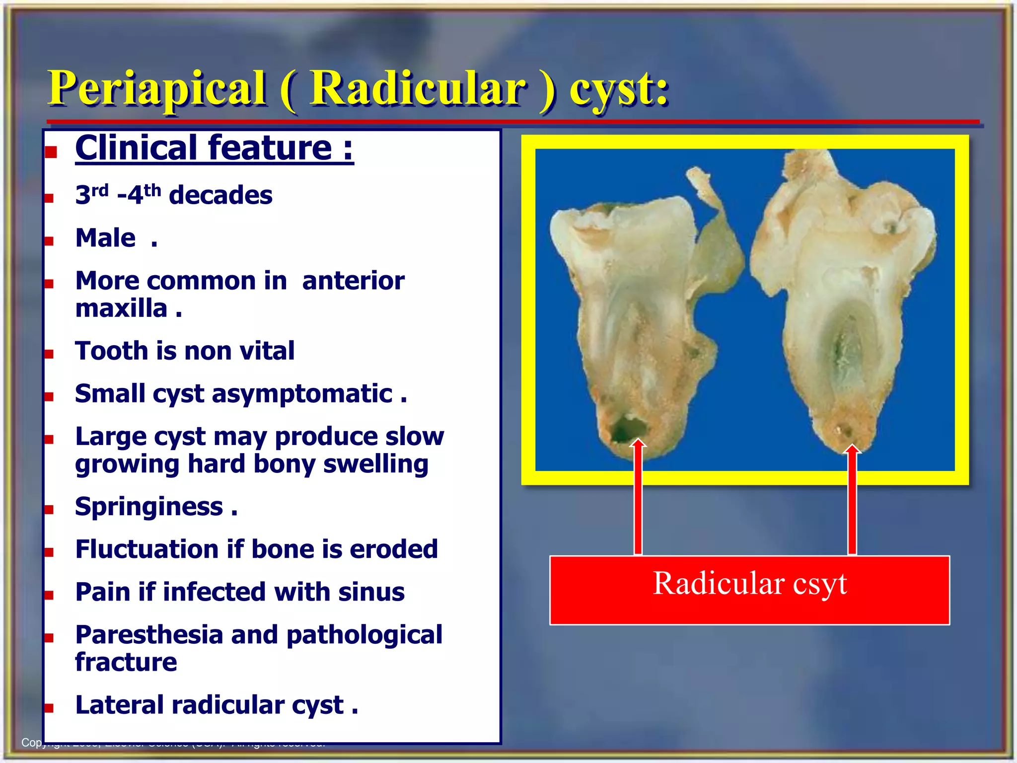 Jaw bone cyst | PPTX