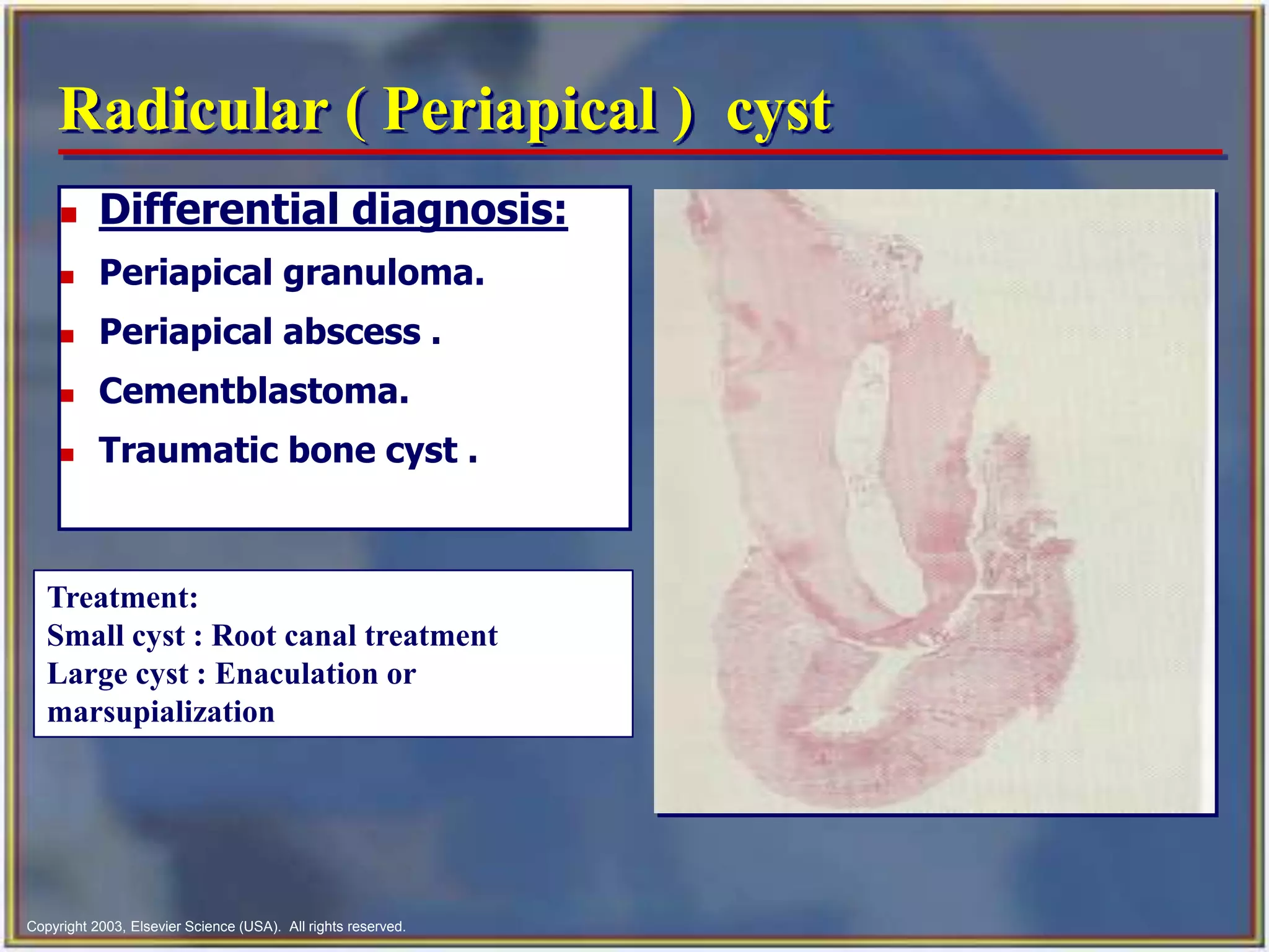 Jaw bone cyst | PPTX