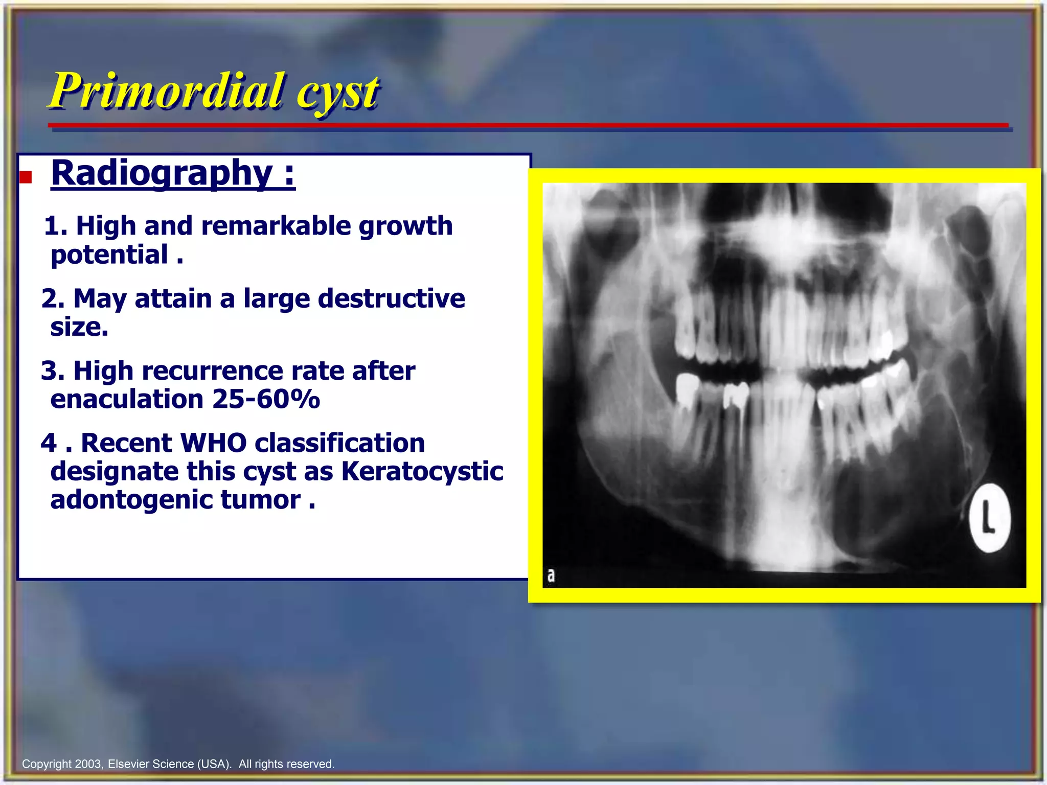 Jaw bone cyst | PPTX