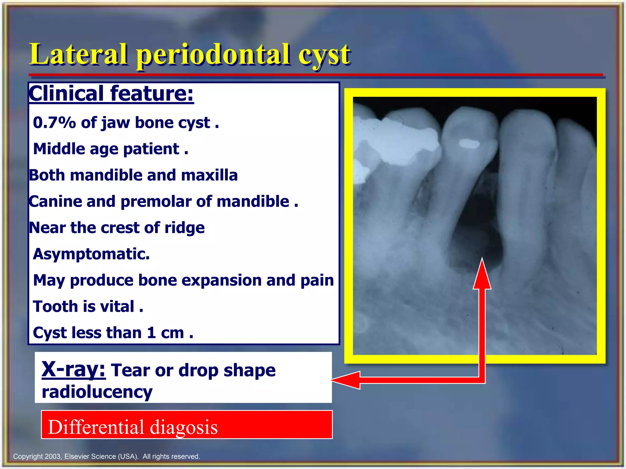 Jaw bone cyst | PPTX