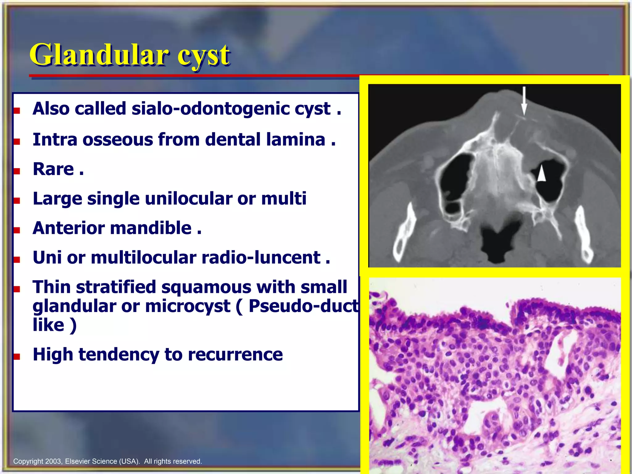 Jaw bone cyst | PPTX