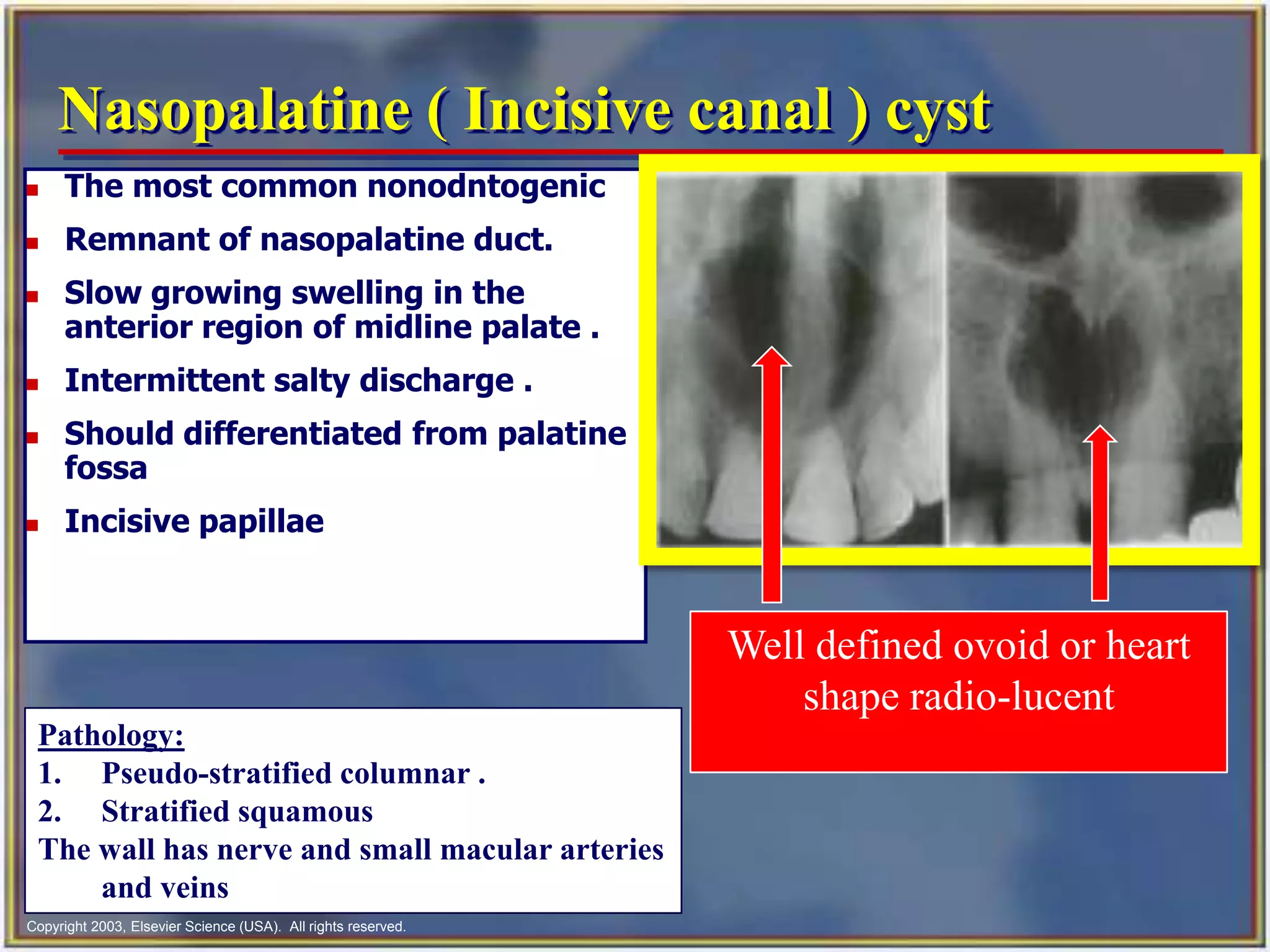 Jaw bone cyst | PPTX