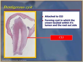 Jaw bone cyst | PPTX