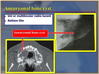 Jaw bone cyst | PPTX