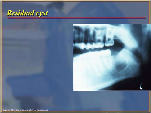 Jaw bone cyst | PPTX