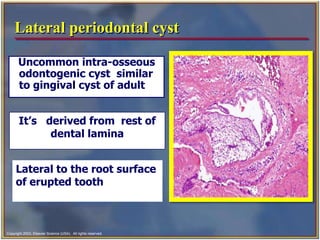 Lateral Periodontal Cyst Histology