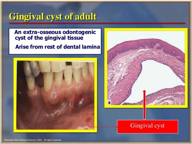 Gingival Cysts Of Newborn Gingival Cyst Of Adult Odontogenesis,