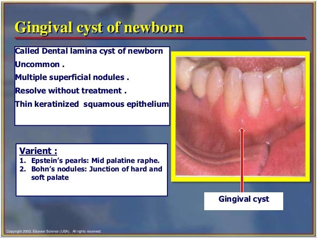 Gingival Cyst Of The Newborn Congenital Epulis And Differential